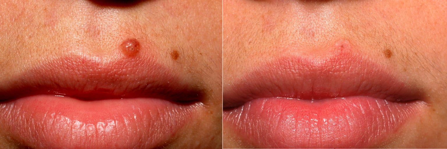 Remove Moles & Scars with a Non-Invasive Mole Removal Surgery